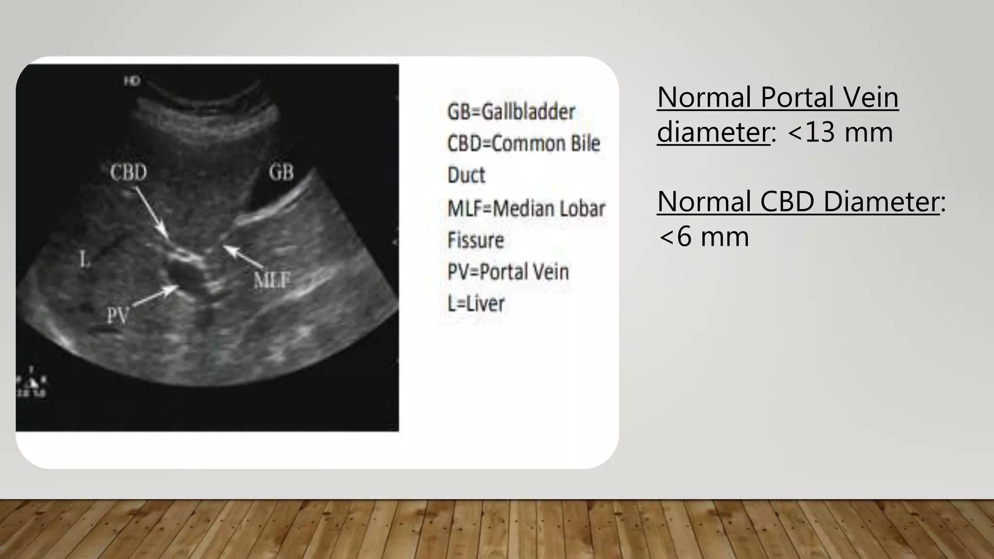 Radiological anatomy of biliary system | PPTX