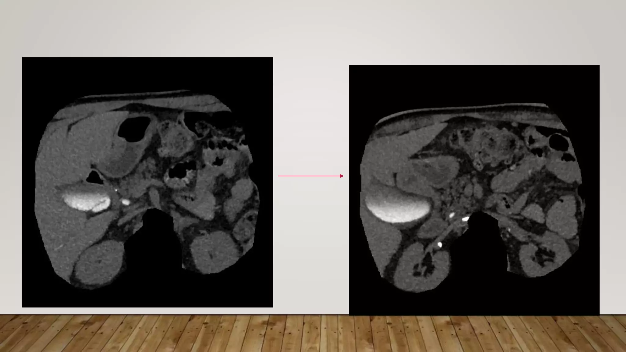 Radiological anatomy of biliary system | PPTX
