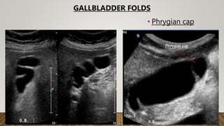 Radiological anatomy of biliary system | PPTX