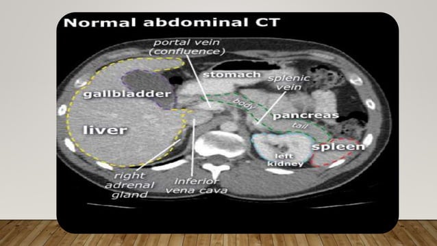 Radiological anatomy of biliary system | PPTX