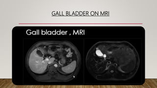 Radiological anatomy of biliary system | PPTX