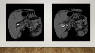 Radiological anatomy of biliary system | PPTX