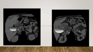 Radiological anatomy of biliary system | PPTX