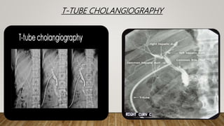 Radiological anatomy of biliary system | PPTX