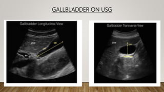 Radiological anatomy of biliary system | PPTX