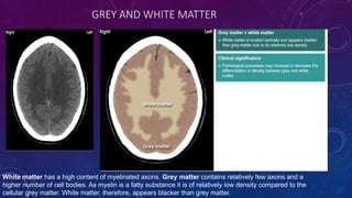 RADIOLOGICAL ANATOMY OF BRAIN.pptx………….. | PPTX