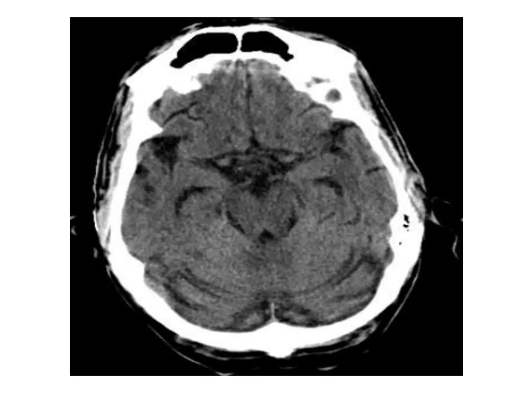 CT and MRI anatomy of brain | PDF