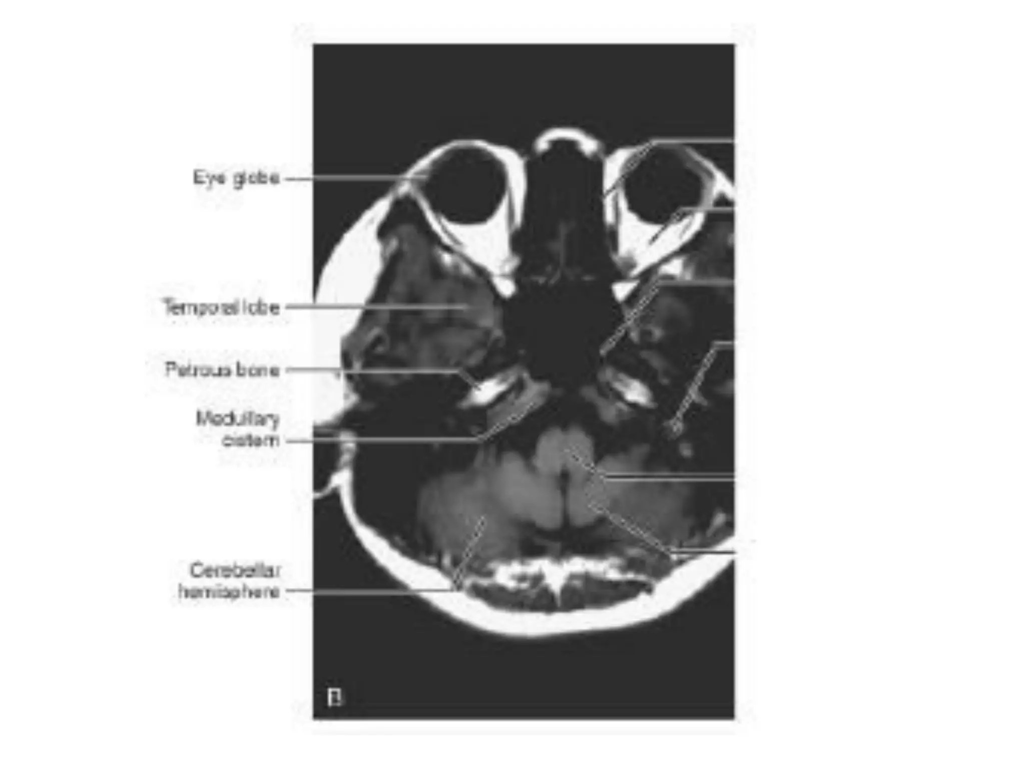 CT and MRI anatomy of brain | PDF