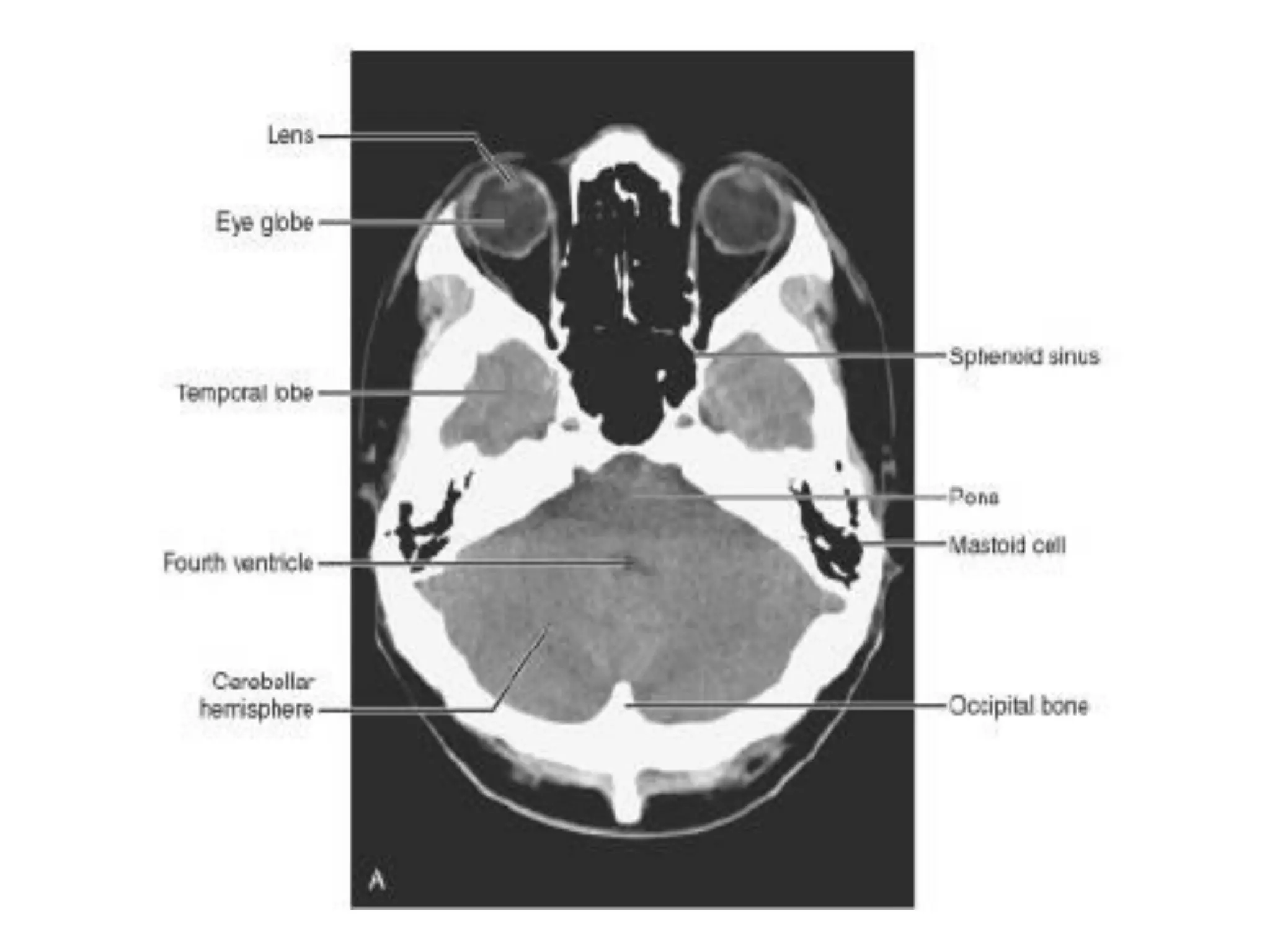 Ct Anatomy Of Brain Ppt