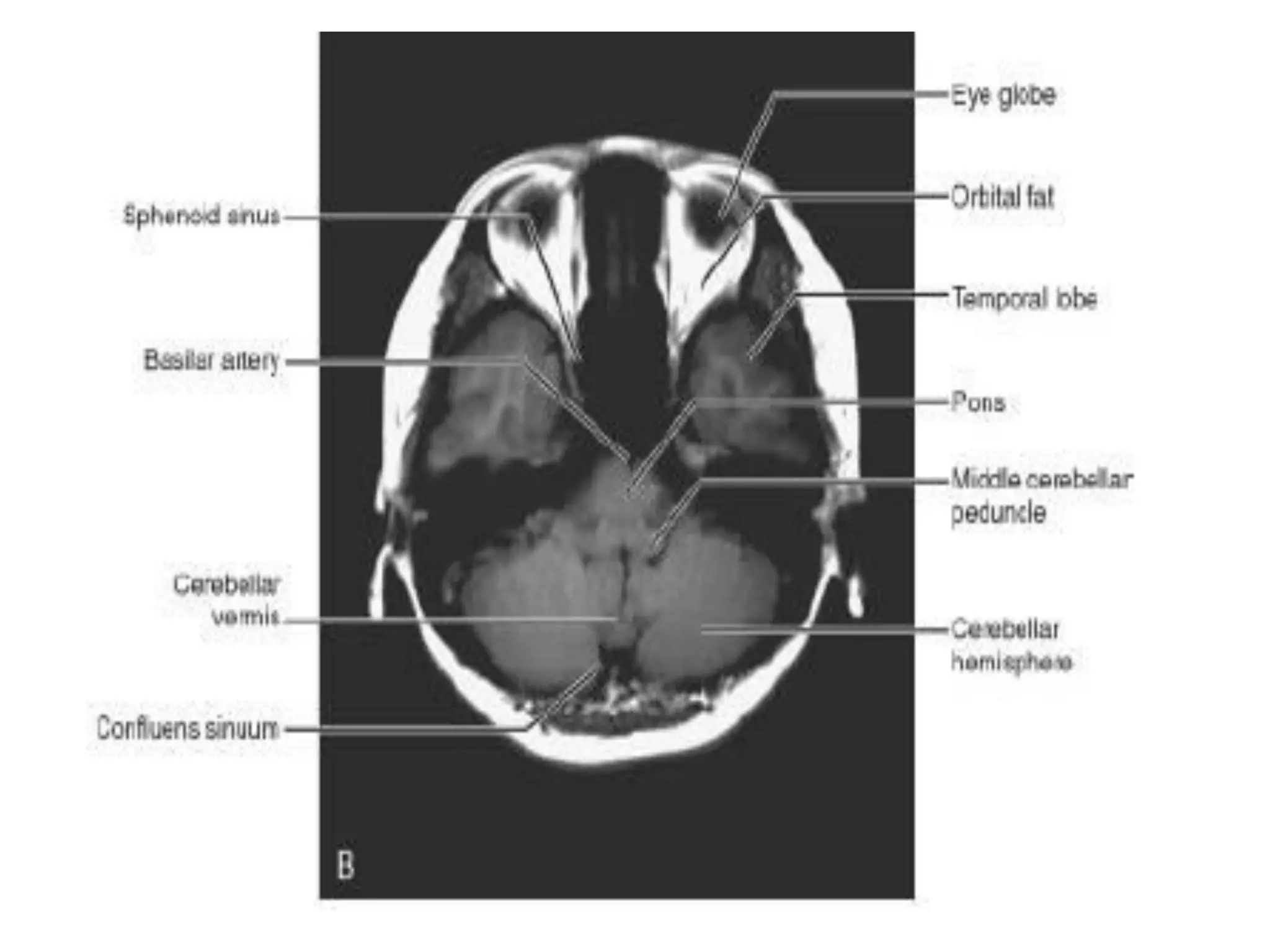 CT and MRI anatomy of brain | PDF | Brain and Nervous System Disorders ...