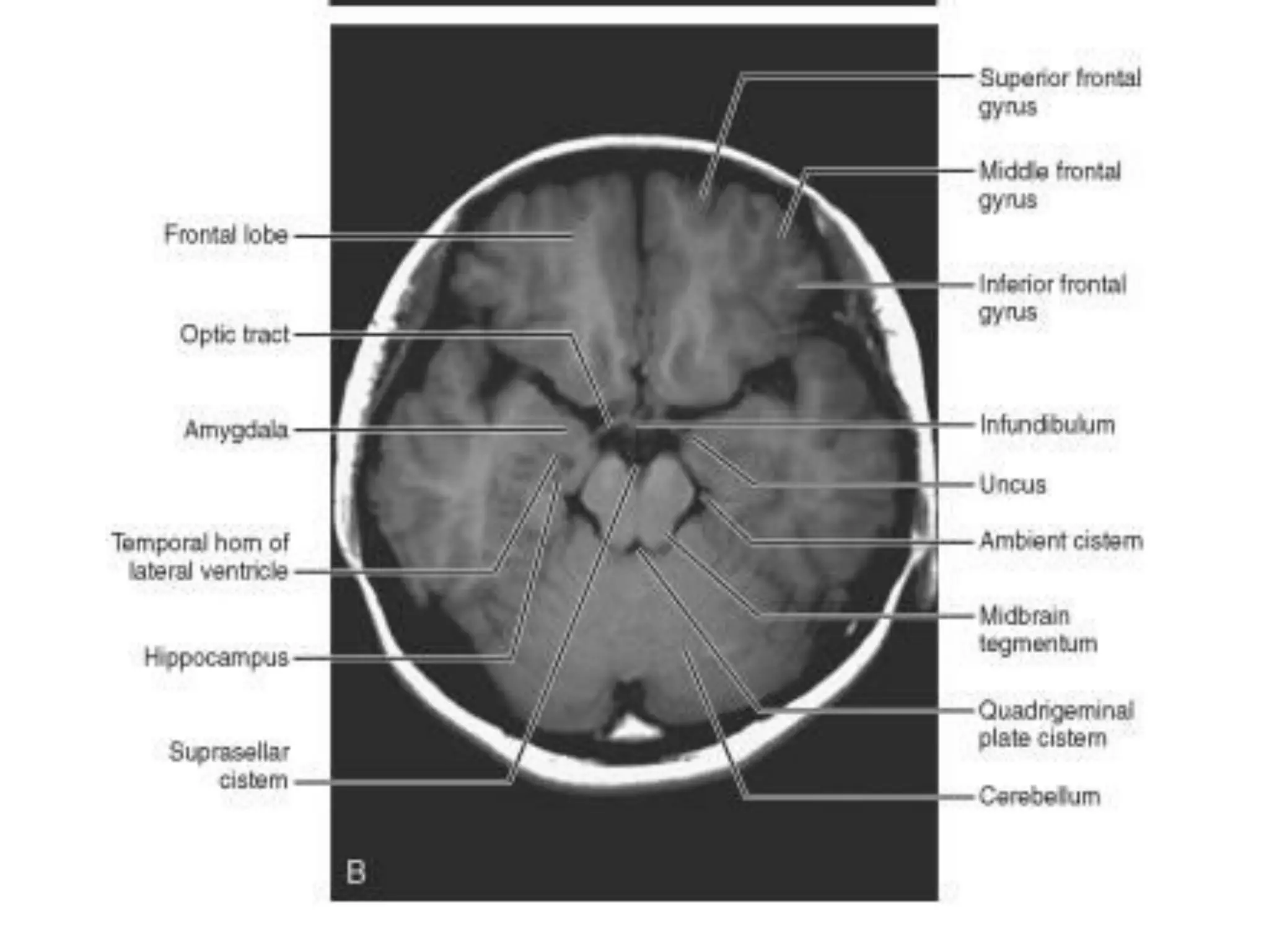 CT and MRI anatomy of brain | PDF | Brain and Nervous System Disorders ...