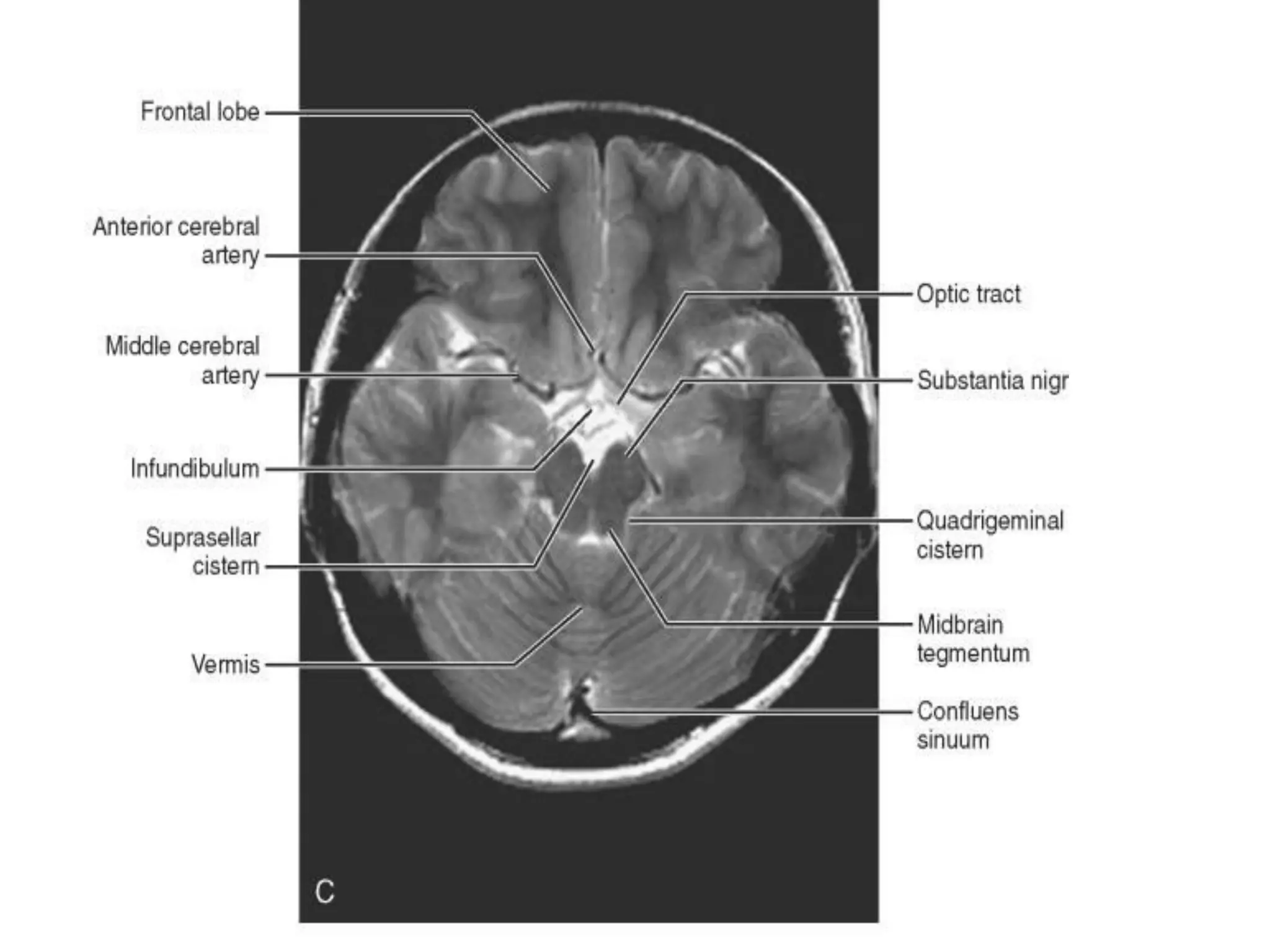 Axial Mri Brain Anatomy