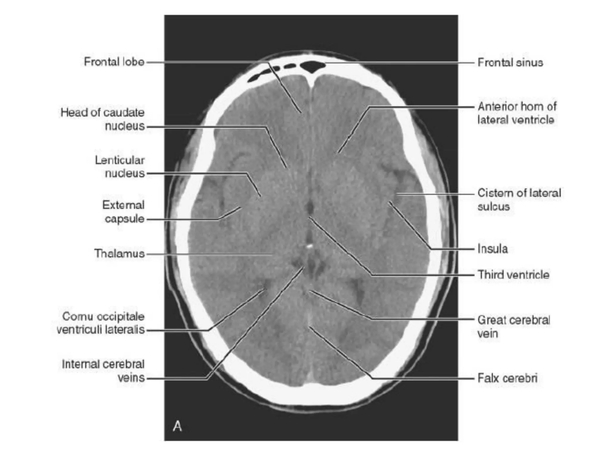 CT and MRI anatomy of brain | PDF