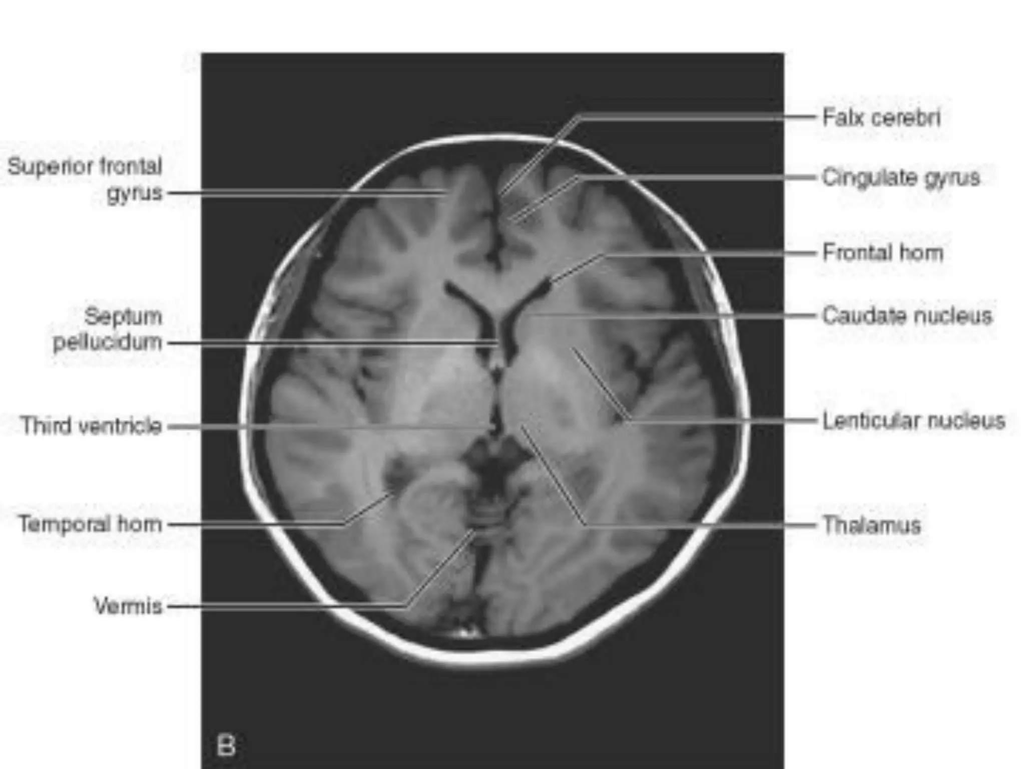 CT and MRI anatomy of brain | PDF | Brain and Nervous System Disorders ...