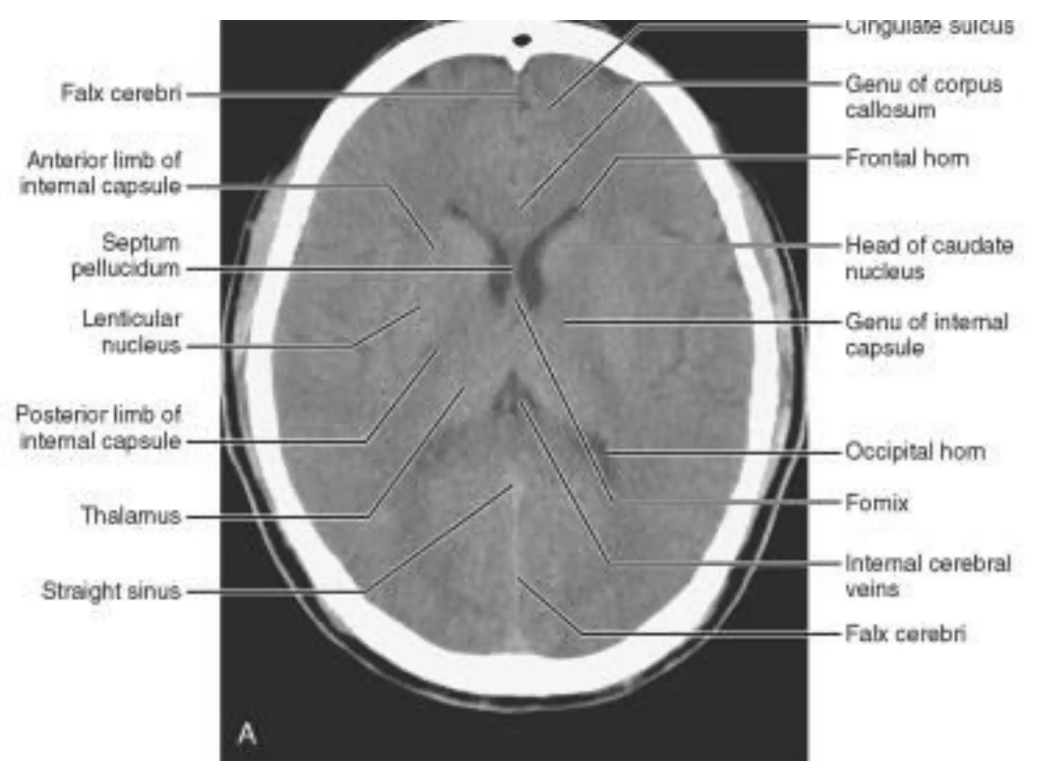 CT and MRI anatomy of brain | PDF | Brain and Nervous System Disorders ...