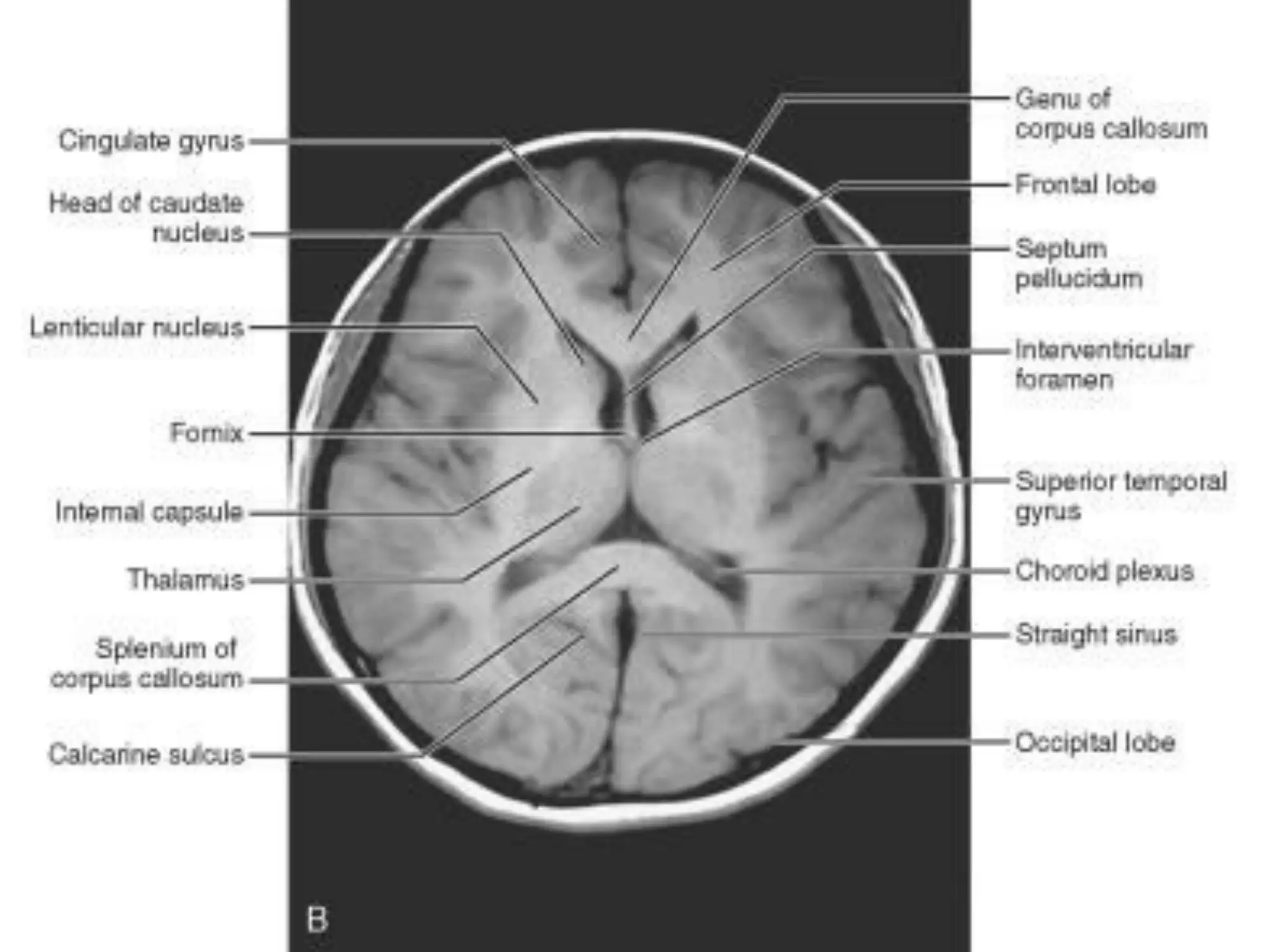 CT and MRI anatomy of brain | PDF