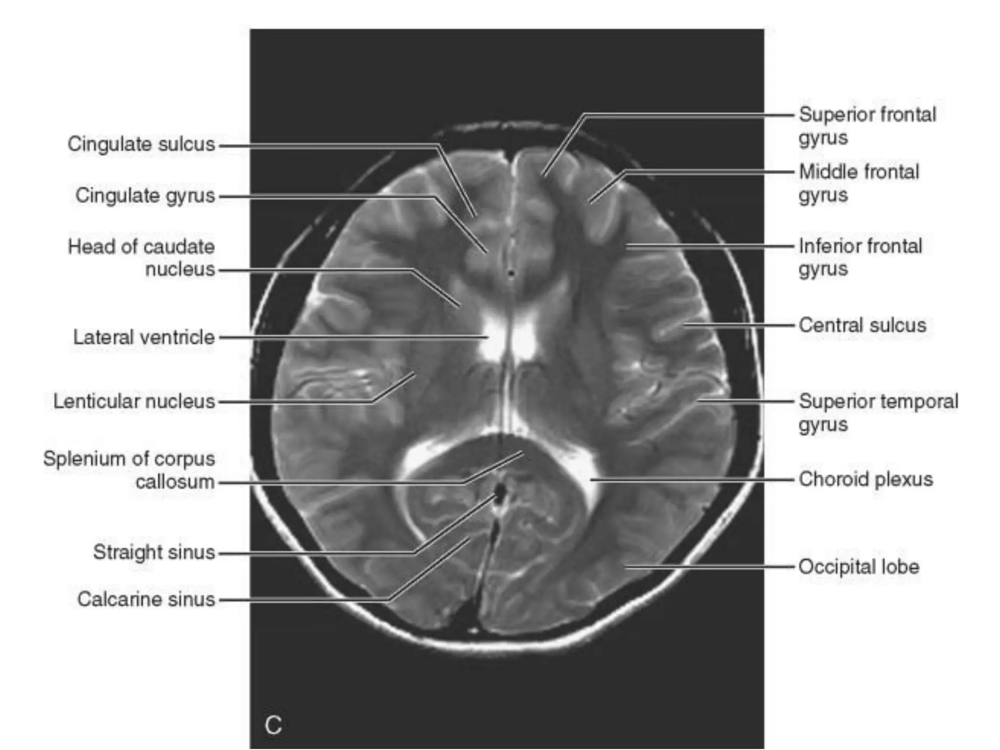 CT and MRI anatomy of brain | PDF | Brain and Nervous System Disorders ...
