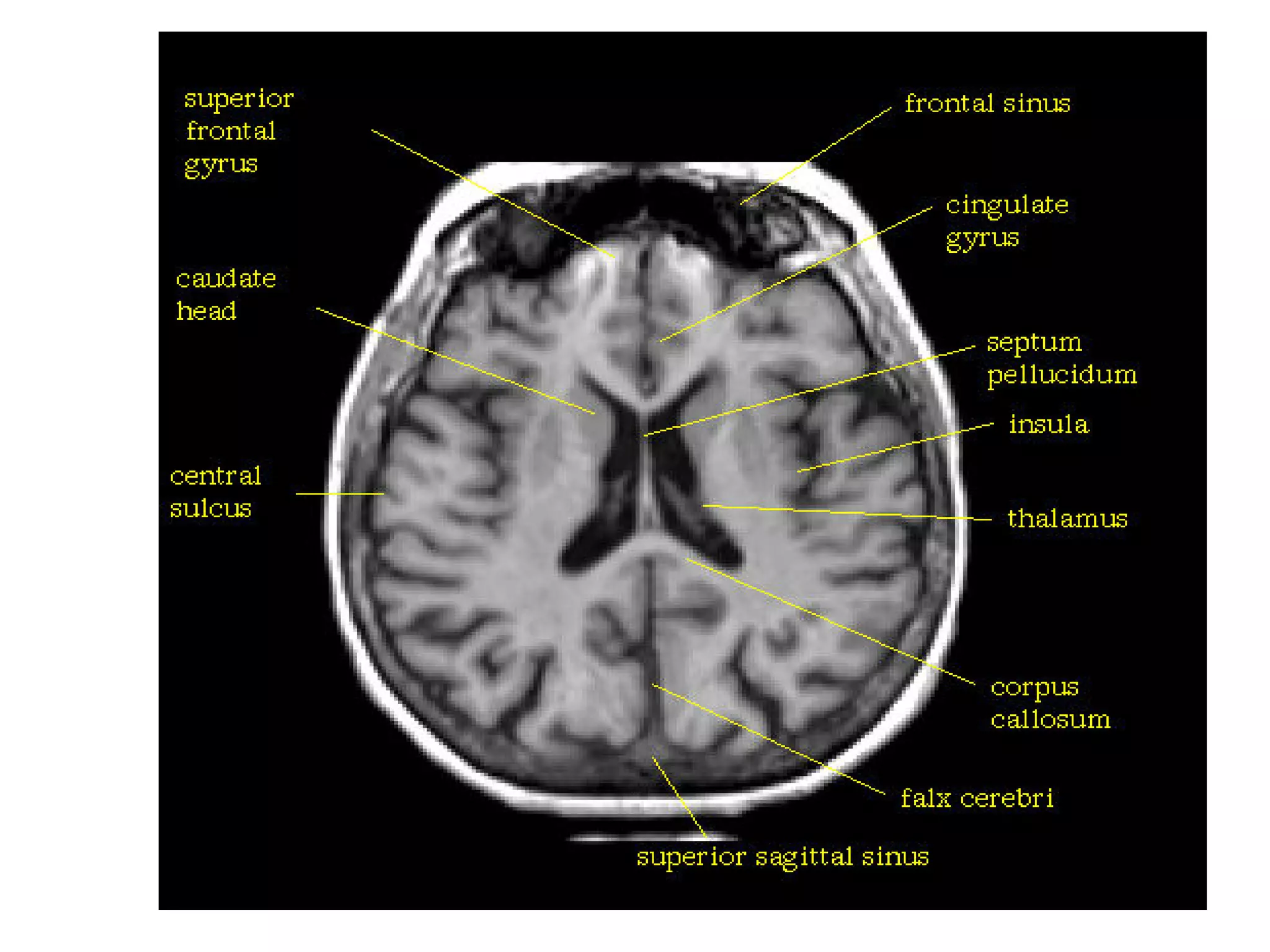 CT and MRI anatomy of brain | PDF