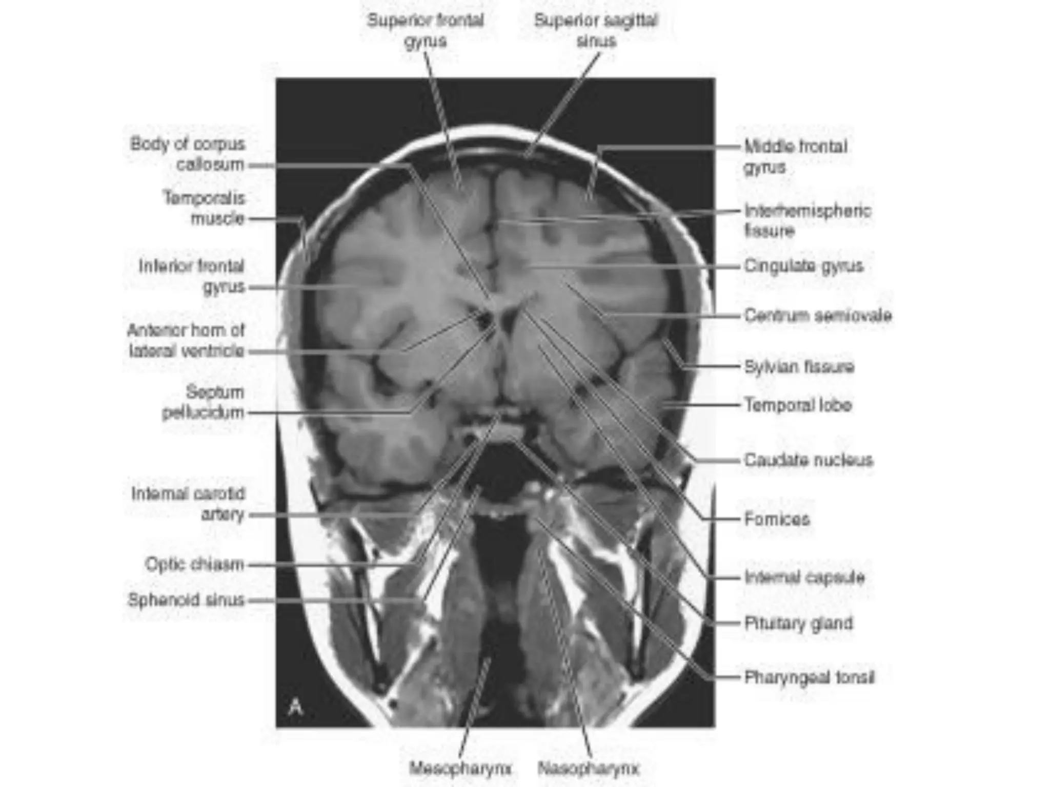 CT and MRI anatomy of brain | PDF