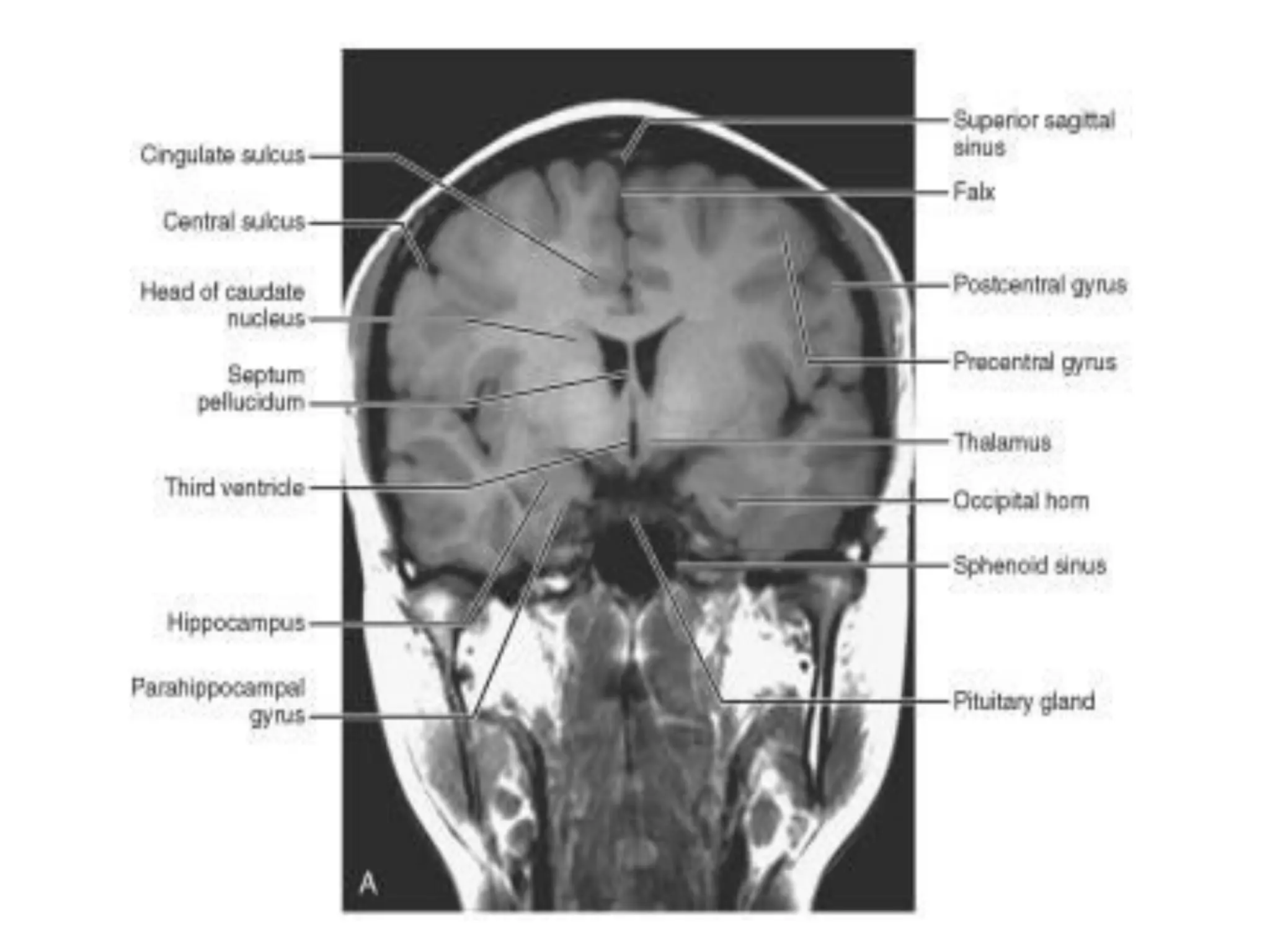 CT and MRI anatomy of brain | PDF