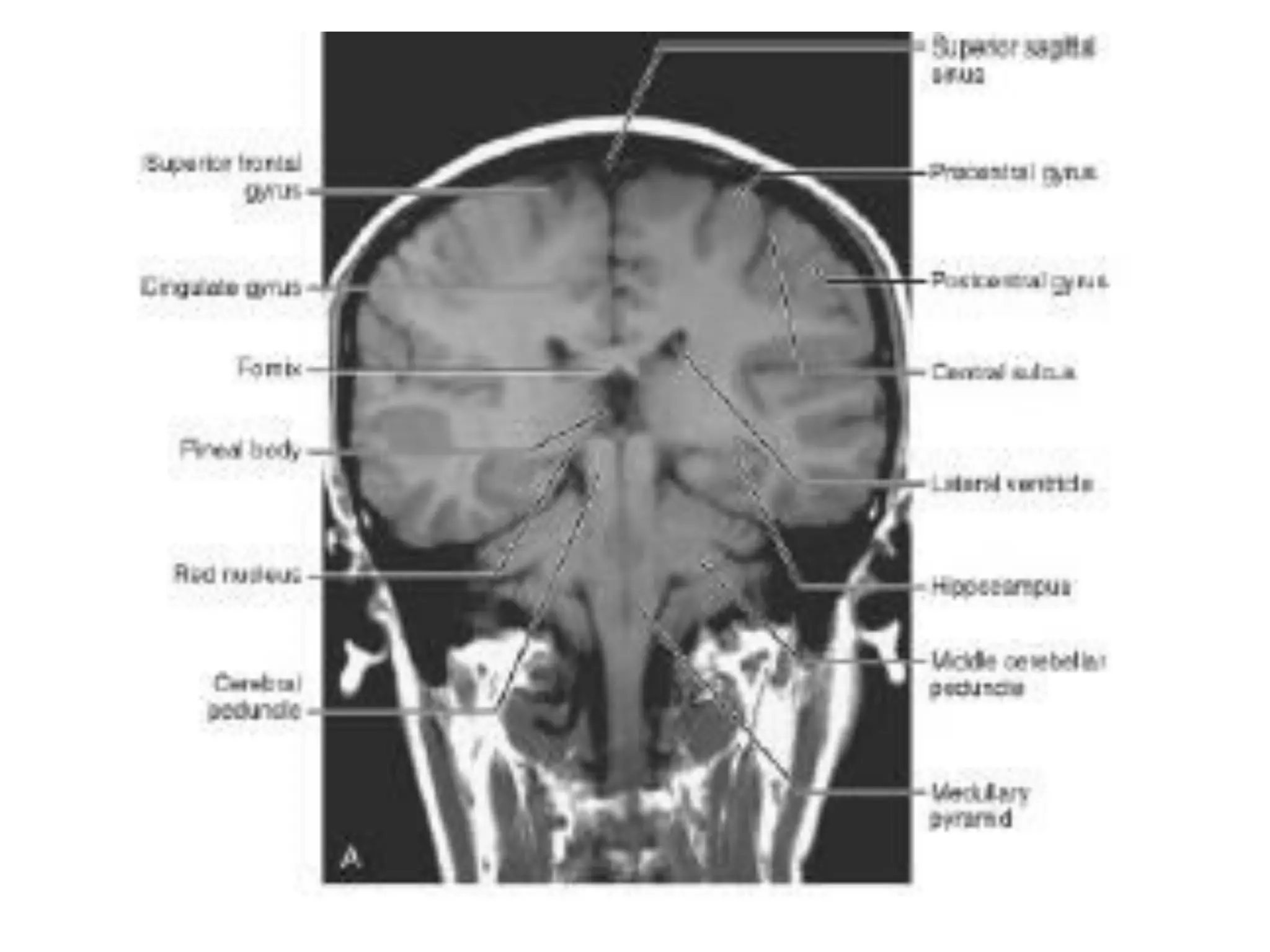 CT and MRI anatomy of brain | PDF