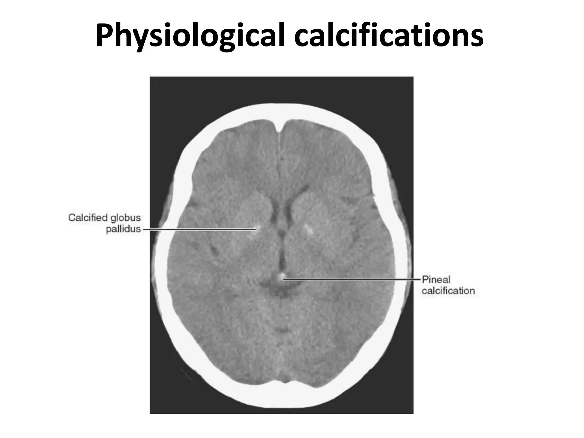 CT and MRI anatomy of brain | PDF