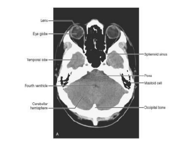 CT and MRI anatomy of brain | PDF | Brain and Nervous System Disorders ...