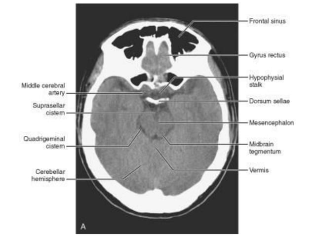 CT and MRI anatomy of brain | PDF | Brain and Nervous System Disorders ...