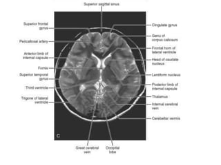 CT and MRI anatomy of brain | PPT