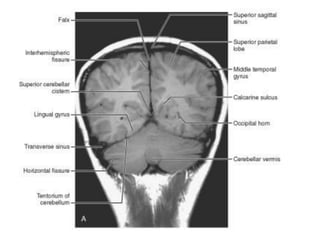 CT and MRI anatomy of brain | PPT