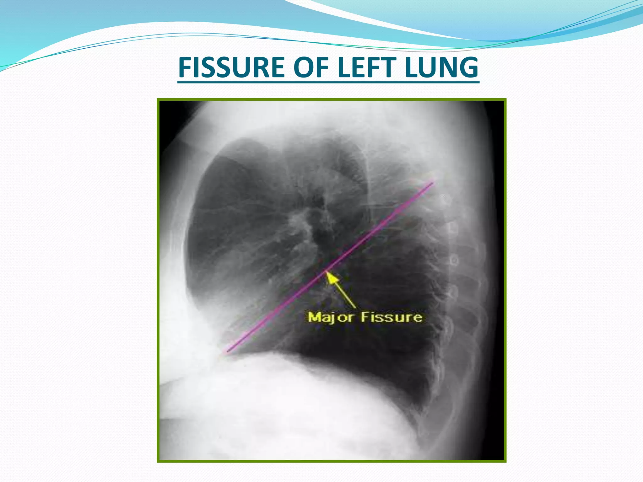 Radiological anatomy of chest including lungs,mediastinum and thoracic ...