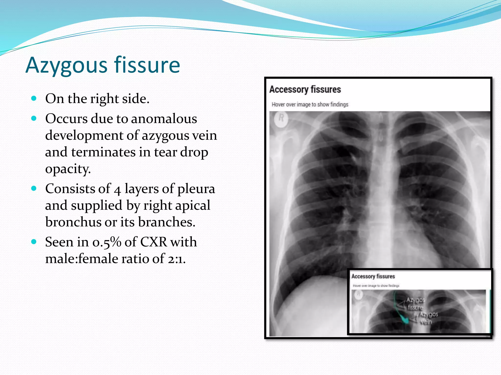 Radiological anatomy of chest including lungs,mediastinum and thoracic ...