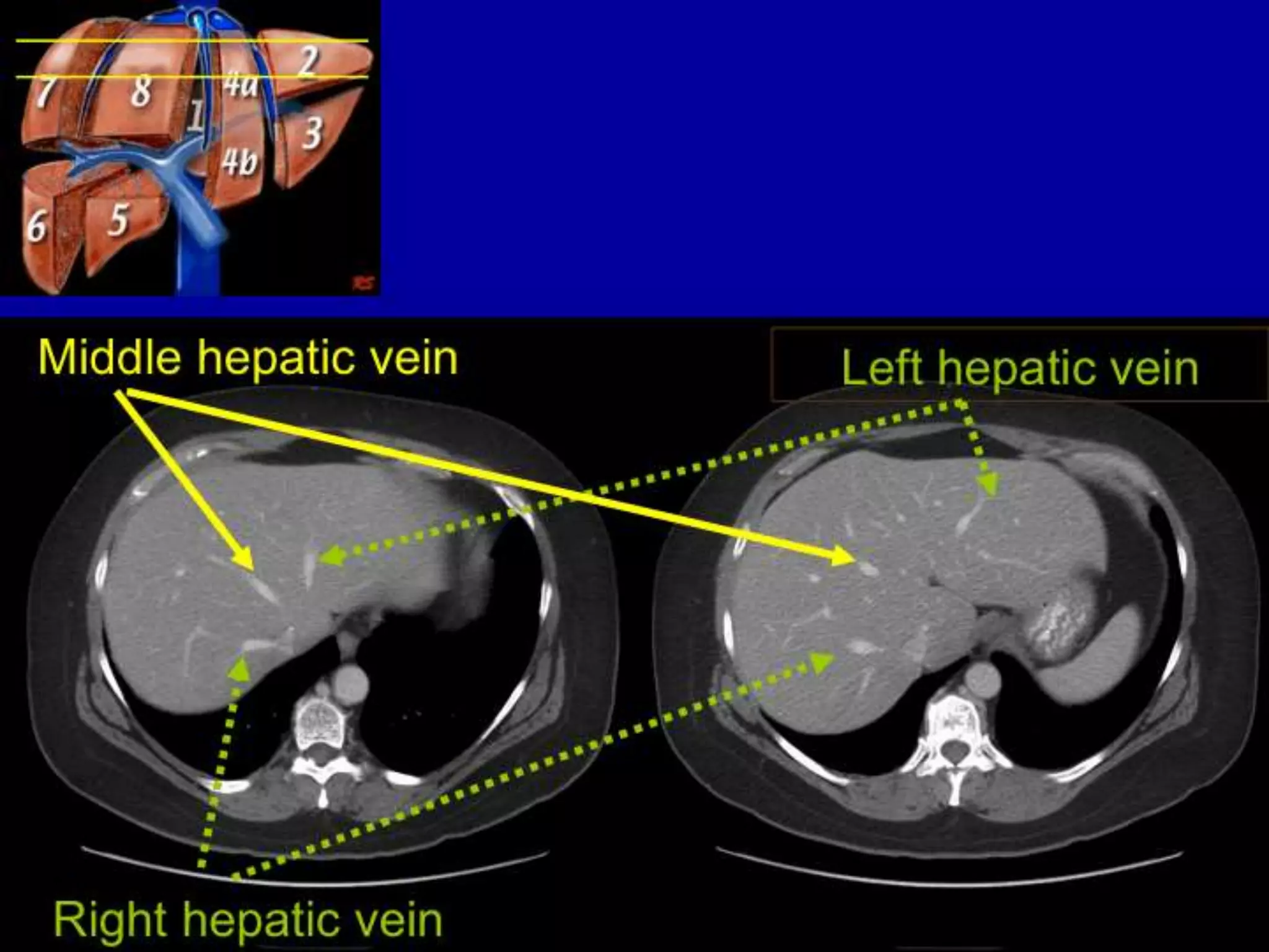Radiological anatomy of hepatobiliary system | PPTX