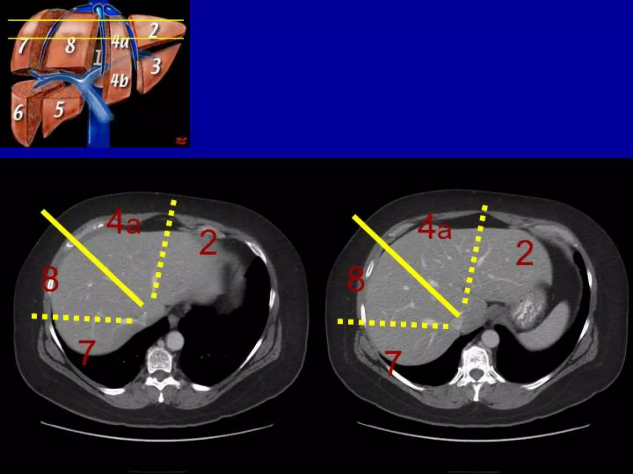 Radiological anatomy of hepatobiliary system | PPTX