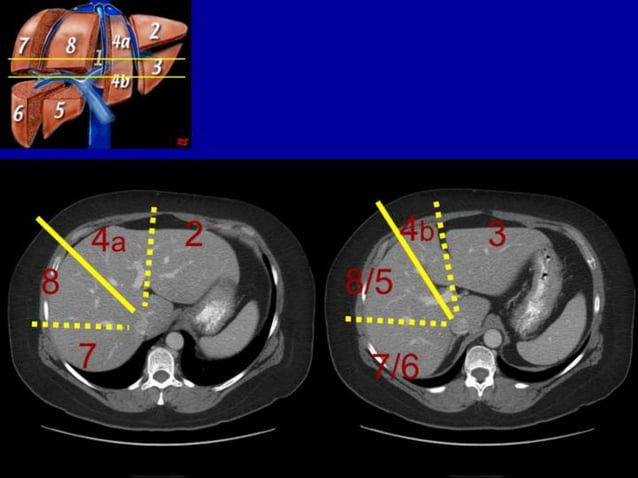 Radiological anatomy of hepatobiliary system | PPTX