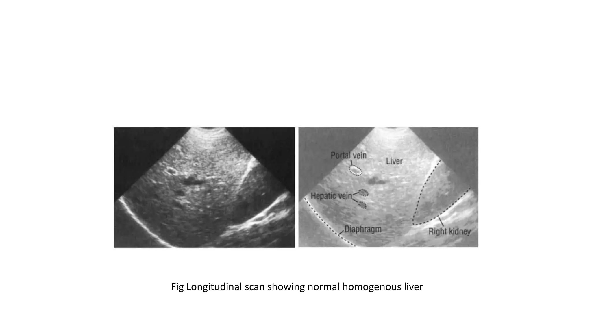 Radiological anatomy of hepatobiliary system | PPTX