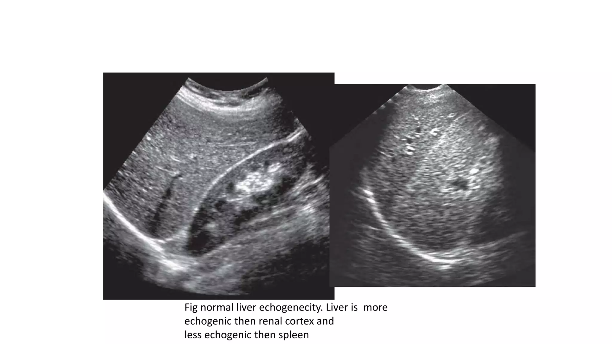 Radiological anatomy of hepatobiliary system | PPTX
