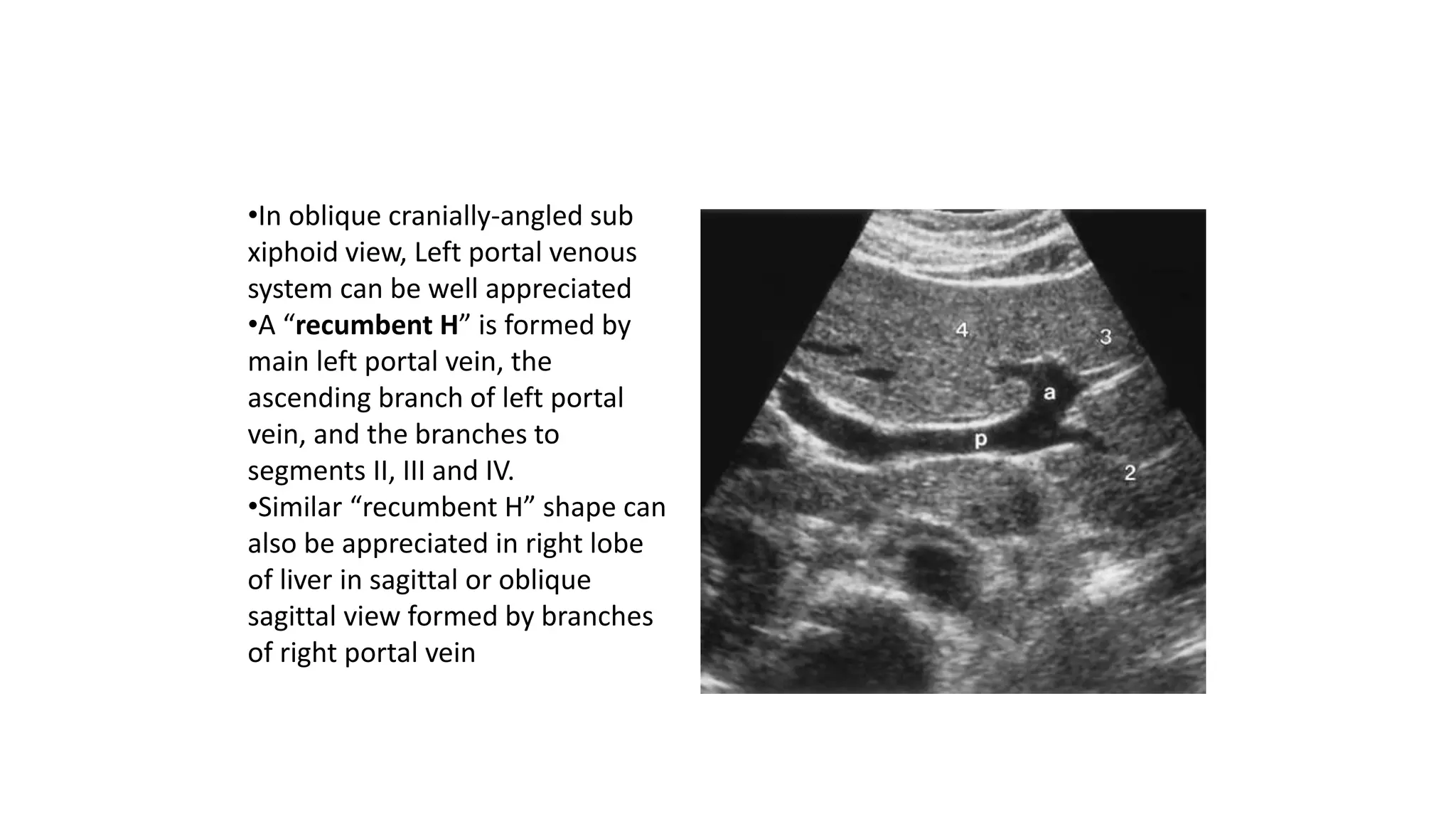 Radiological anatomy of hepatobiliary system | PPTX
