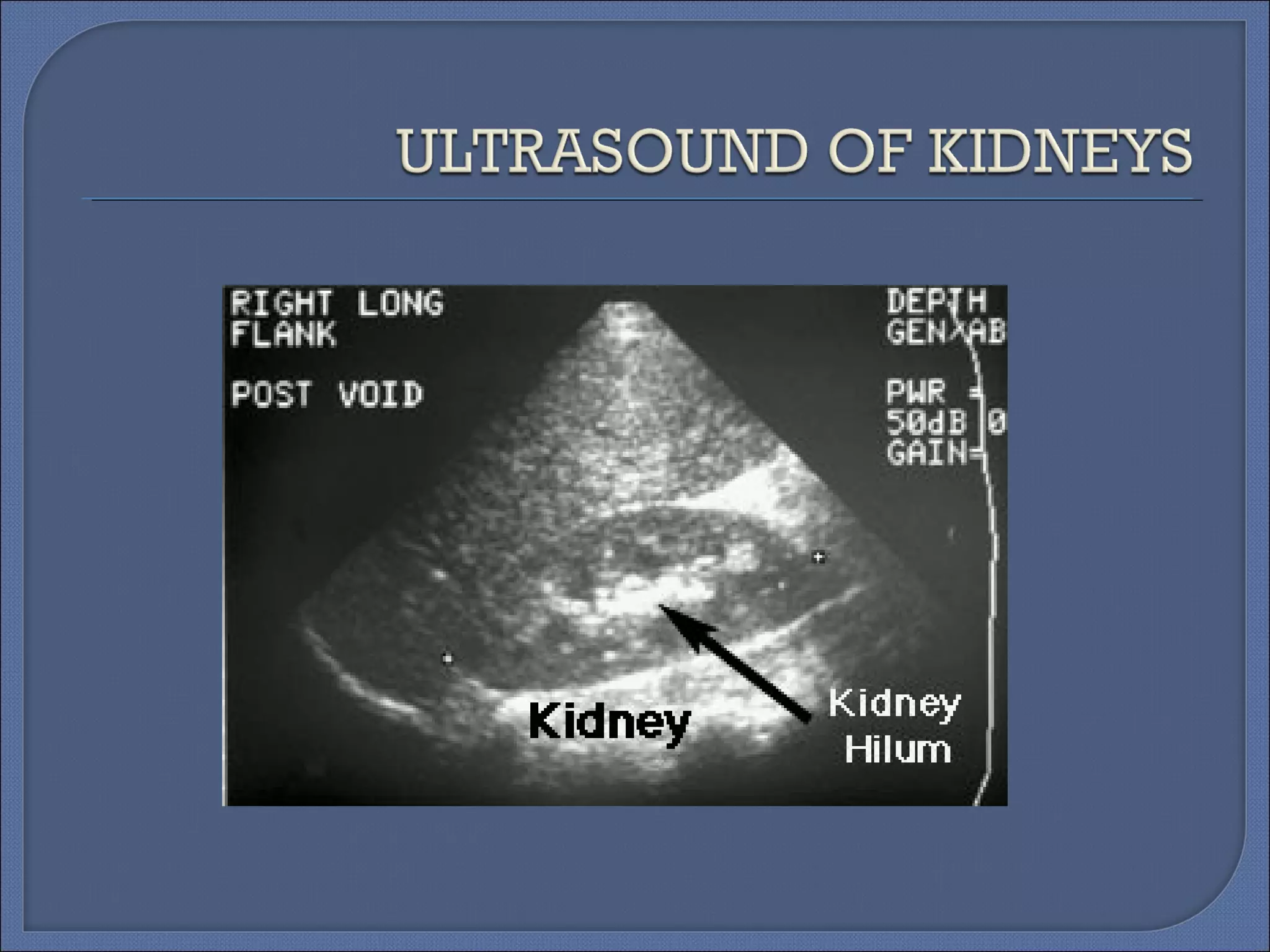 Radiological anatomy of kidney, ureter & bladder | PPT