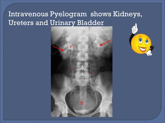 Radiological anatomy of kidney, ureter & bladder | PPT