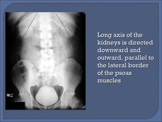 Radiological anatomy of kidney, ureter & bladder | PPT