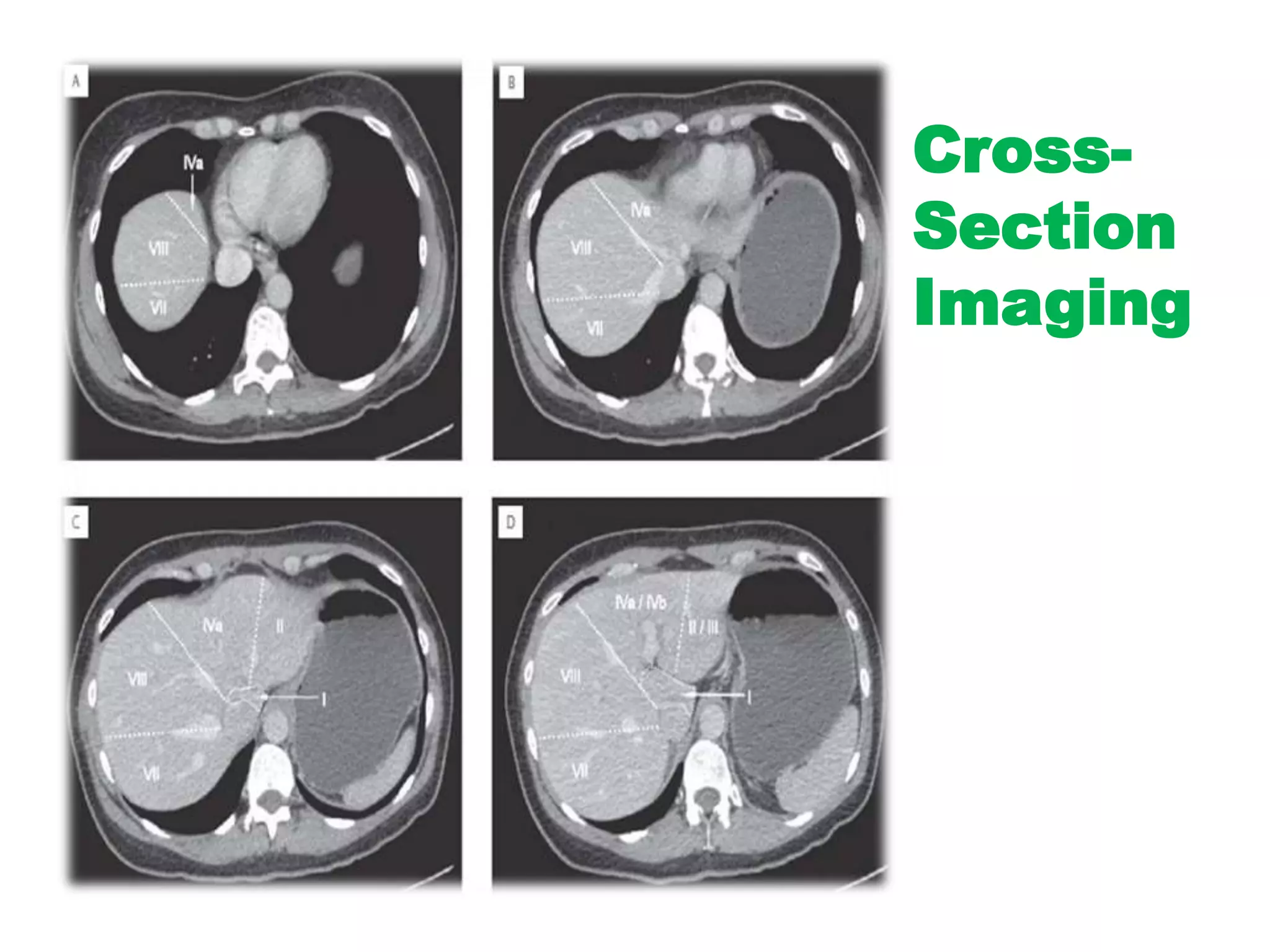 Segmental Anatomy of Liver and its Radiological Correlation | PPTX