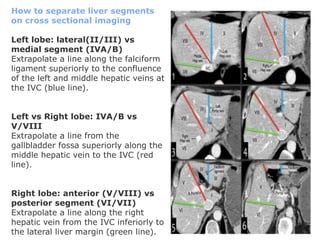 Segmental Anatomy of Liver and its Radiological Correlation | PPTX
