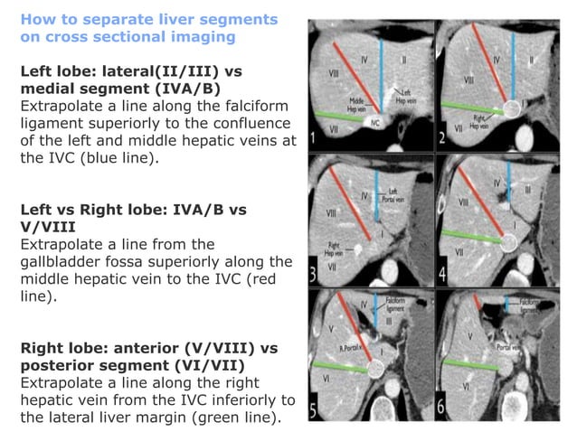 Segmental Anatomy of Liver and its Radiological Correlation | PPTX ...