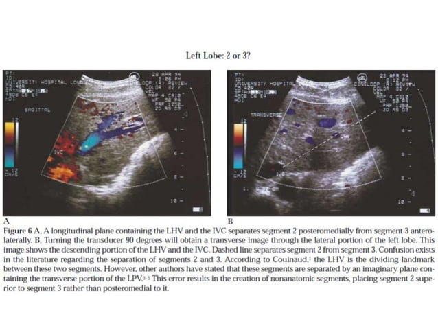 Radiological anatomy of liver segments | PPTX