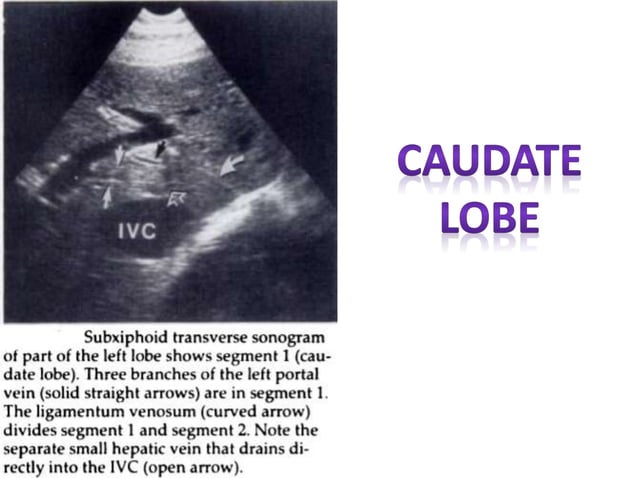 Radiological anatomy of liver segments | PPTX