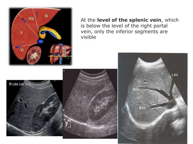 Radiological anatomy of liver segments | PPTX