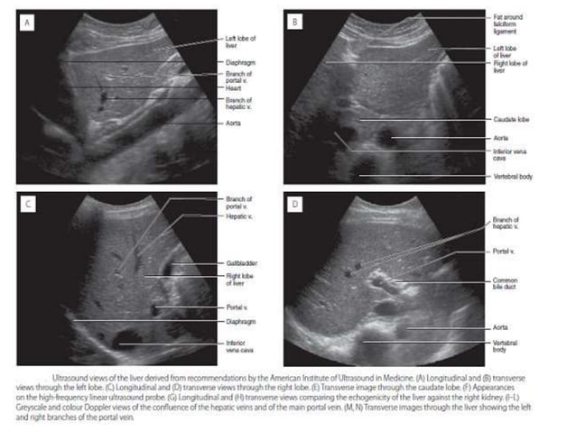 Radiological anatomy of liver segments | PPTX
