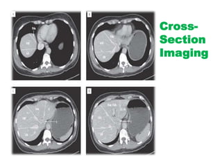 Radiological anatomy of liver segments | PPTX