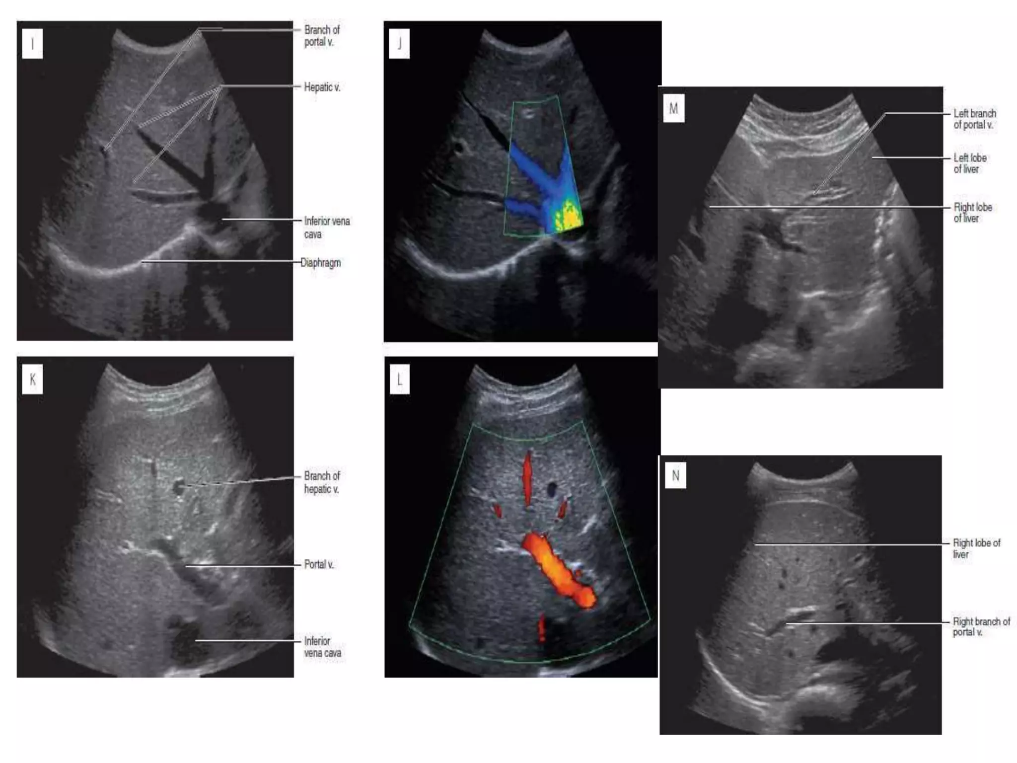 radiological anatomy of liver segments (1).pptx